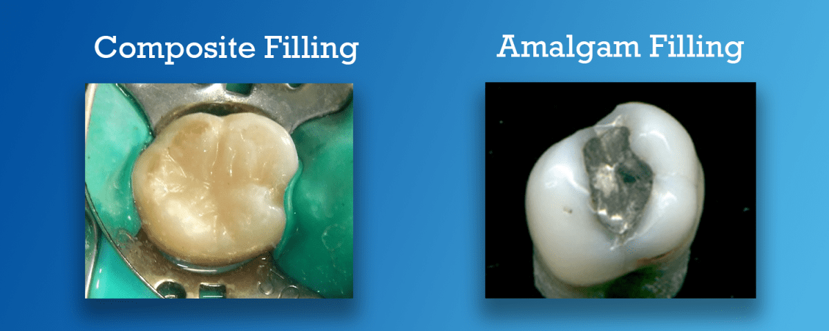 Dental Fillings: Composite and Amalgam Explained
